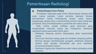 Referat Radiologi Rickets (Rakhitis) | PPTX