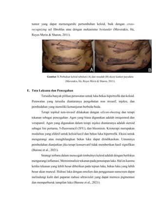 Referat_Rizqi Anisah Yumna_G992202065_Keloid dan Hipertrofik pada ...