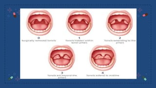REFERAT TONSILITIS tht.pptx