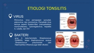 REFERAT TONSILITIS tht.pptx
