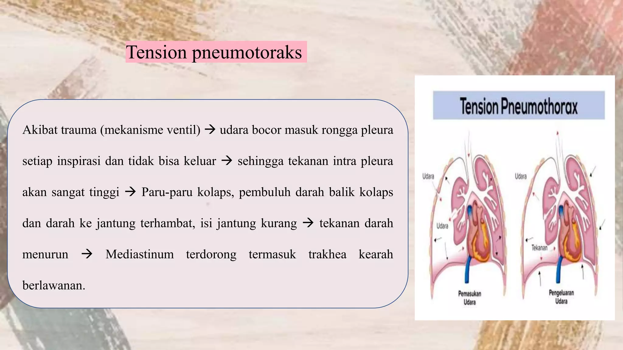 Referat TRAUMA THORAKS Marni.pptx