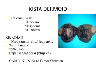 Referat tumor ovarium (ppt) | PPTX