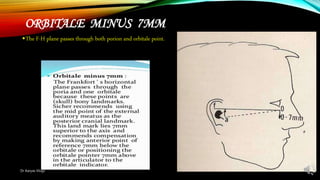 Reference points for facebow | PPTX