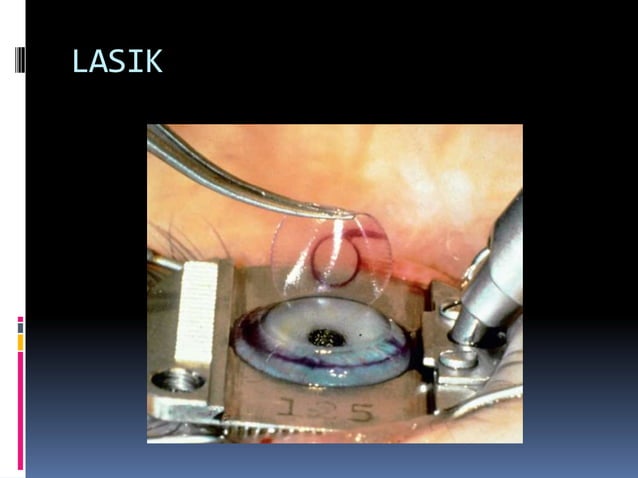 Ref errors. myopia n hypermetropia correction | PPTX