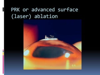 Ref errors. myopia n hypermetropia correction | PPT