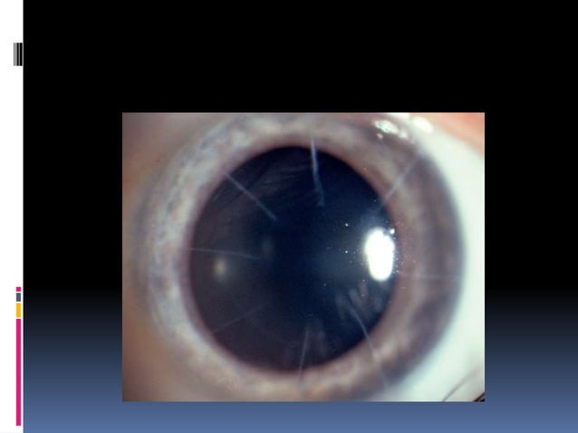 Ref errors. myopia n hypermetropia correction | PPTX