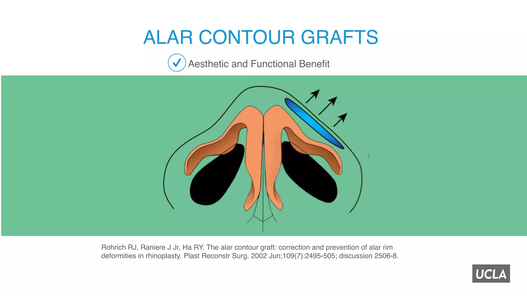 Refinements and advances in rhinoplasty with alar contour grafts | PPT