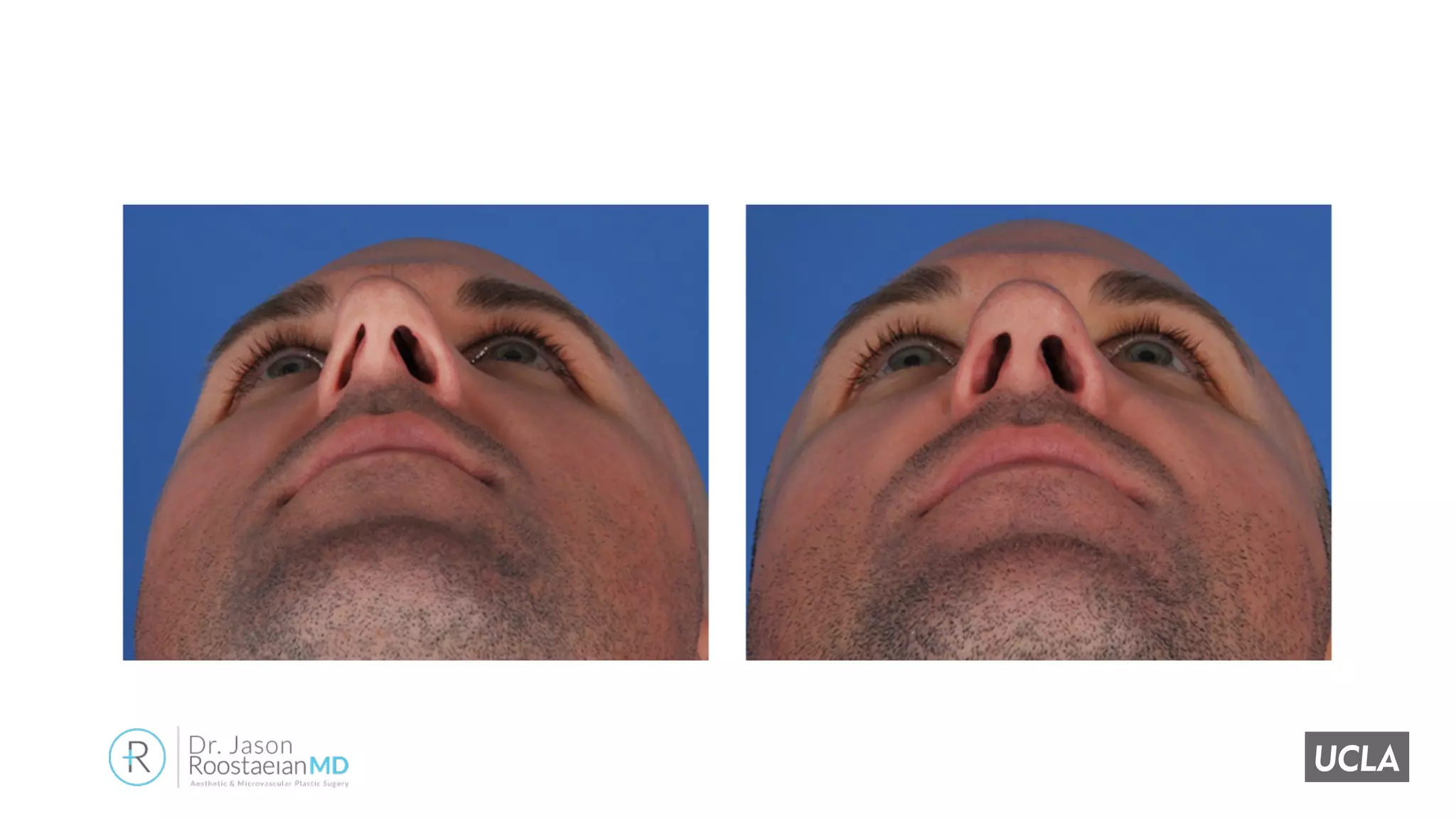 Refinements and advances in rhinoplasty with alar contour grafts | PDF