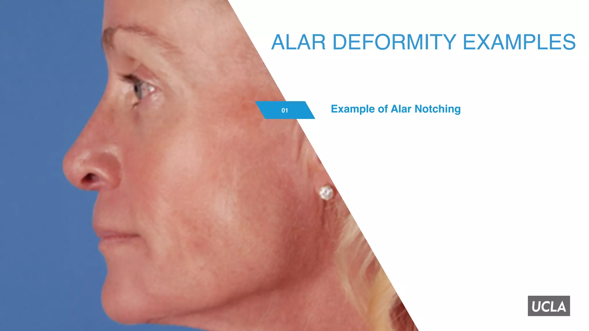 Refinements and advances in rhinoplasty with alar contour grafts | PDF
