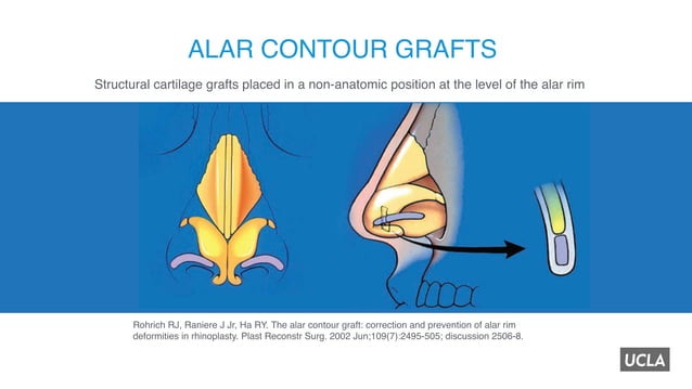 Refinements and advances in rhinoplasty with alar contour grafts | PPT
