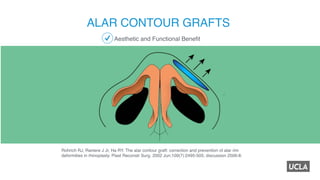 Refinements and advances in rhinoplasty with alar contour grafts | PDF