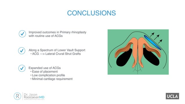 Refinements and advances in rhinoplasty with alar contour grafts | PPT