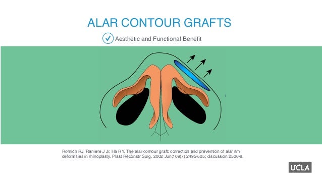 Refinements and advances in rhinoplasty with alar contour grafts