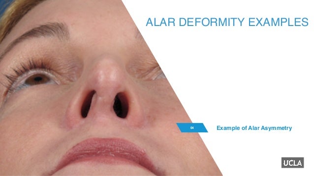 Refinements and advances in rhinoplasty with alar contour grafts