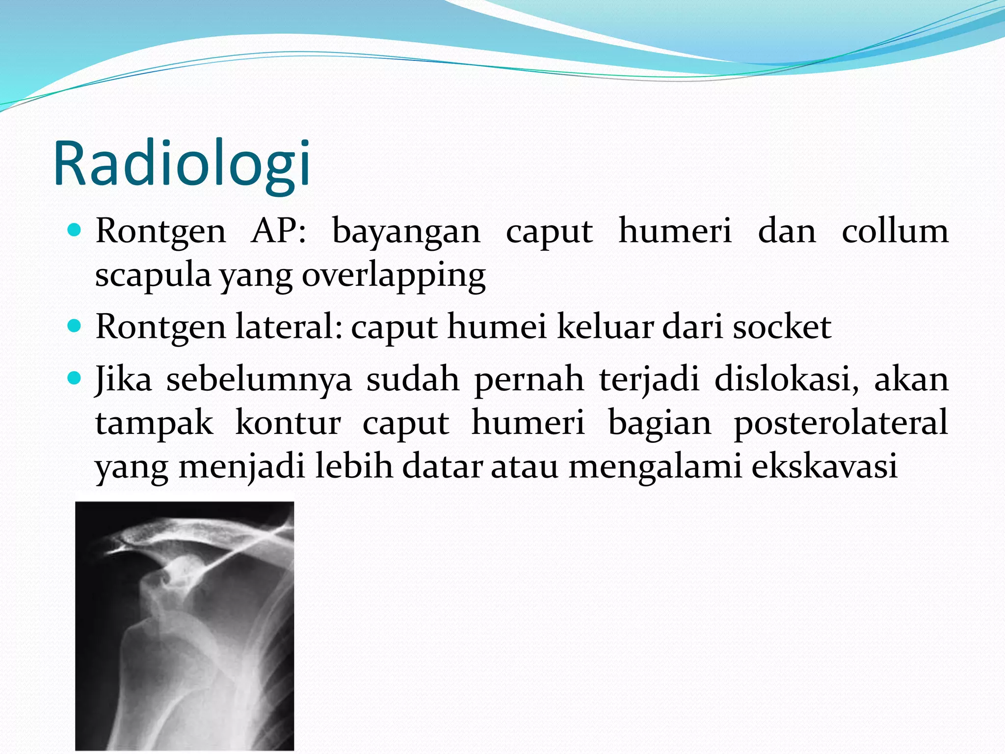 Refkas dislokasi bahu.pptx