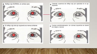 Reflejo del ojo rojo | PPTX