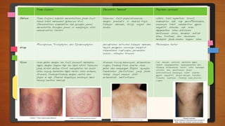 Refleksi kasus Tinea Corporis.pptx