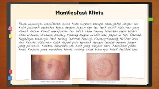 Refleksi kasus Tinea Corporis.pptx