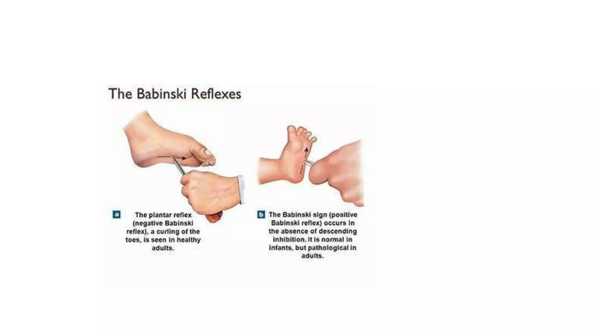 Reflex arc & Babinski sign.pptx