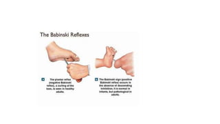 Reflex arc & Babinski sign.pptx | Brain and Nervous System Disorders ...