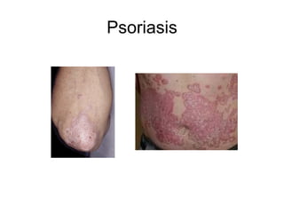 Reflexology-common skin diseases and disorders | PPT