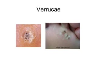 Reflexology-common skin diseases and disorders | PPT