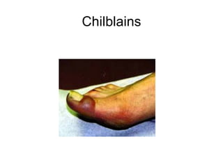 Reflexology-common skin diseases and disorders | PPT