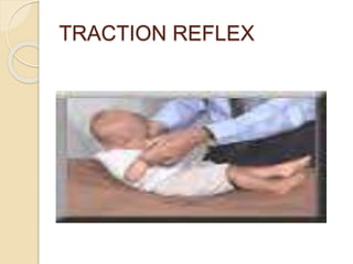 Traction Reflex