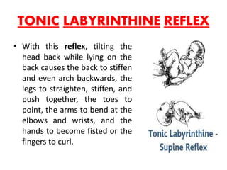 Tonic Labyrinthine Reflex