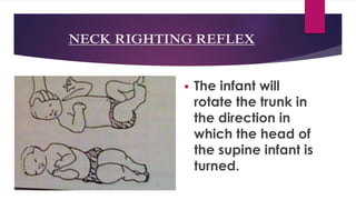 Optical Righting Reflex Infants