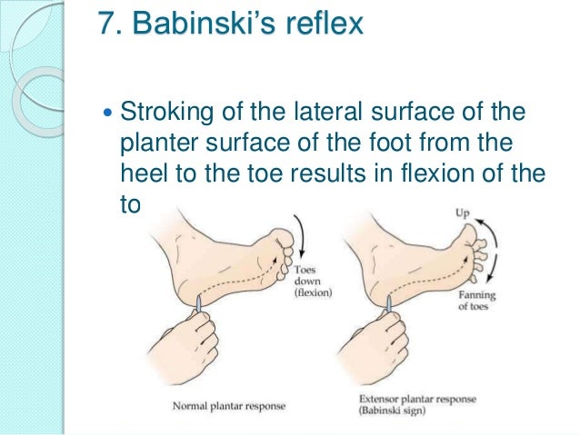 Causes Babinski Reflex Adults - revizionmademt7