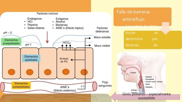 Reflujo laringofaríngeo