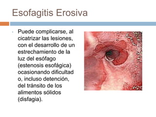 ERGE- Enfermedad de Reflujo Gastroesofagico- Medicina | PPTX