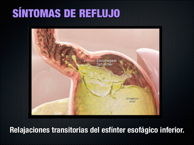 Esfínter Esofágico Inferior