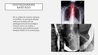 ENFERMEDAD POR REFLUJO GASTROESOFAGICO | PPTX