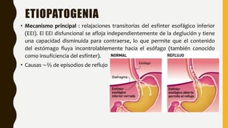 Reflujo gastroesofágico | PPTX