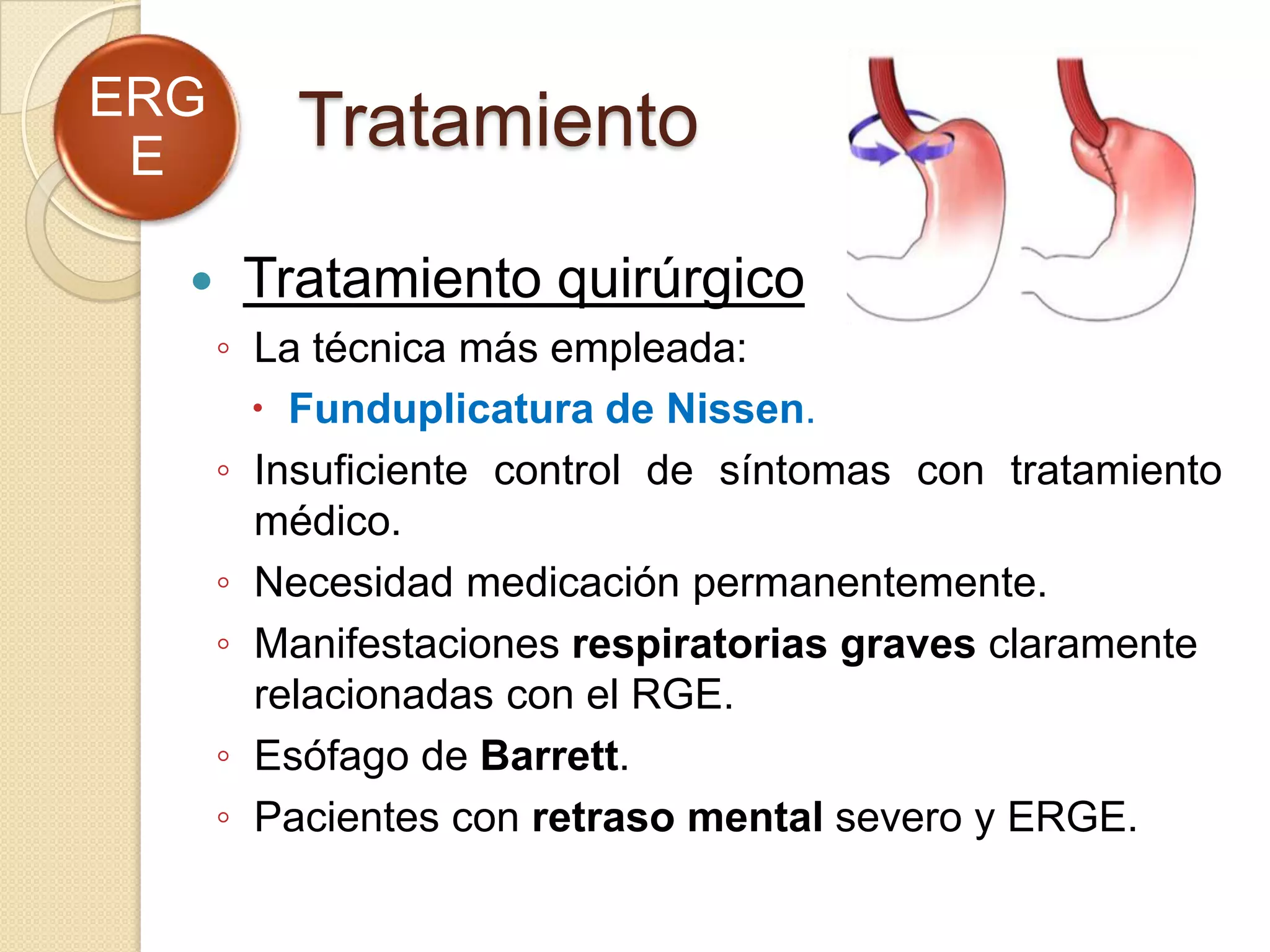 Reflujo gastroesofágico en Pediatría | PPTX