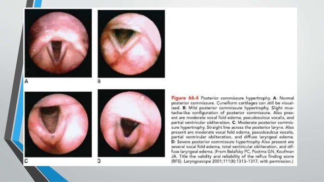 Reflujo laringofaringeo