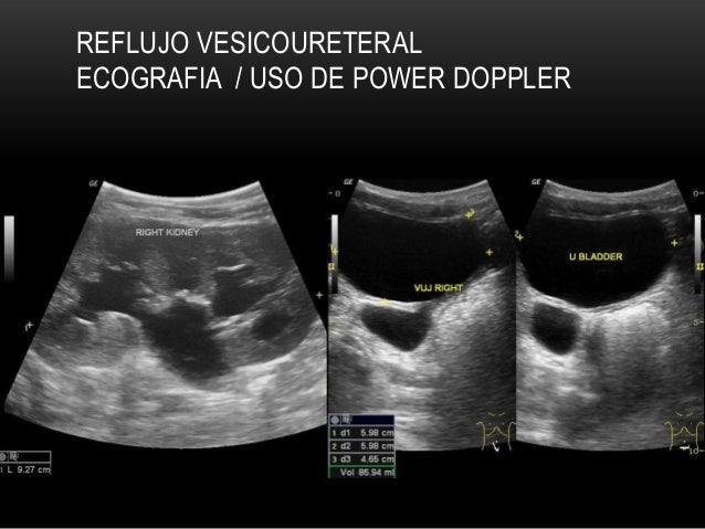 Reflujo vesico ureteral
