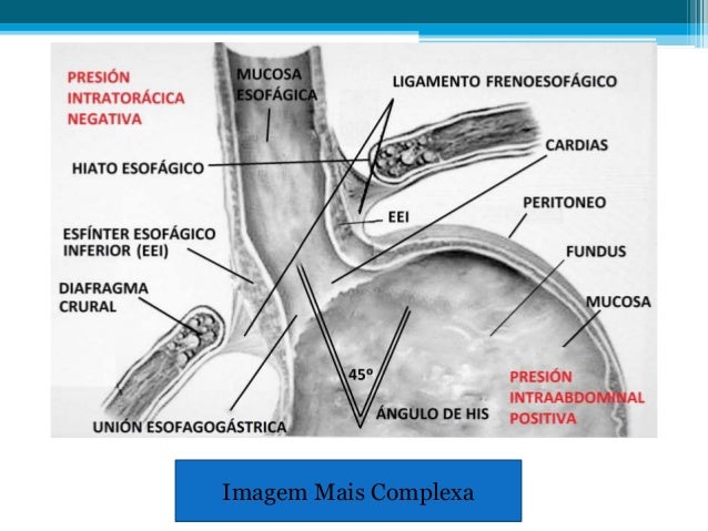 Refluxo gastroesofágico-drge