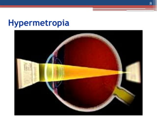 Refraction-II, types of refractive errors | PPTX