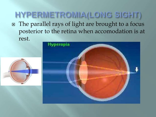Refraction and refractive errors | PPT