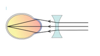 Refractive disorders in ophthalmology.pptx