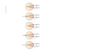 Refractive disorders in ophthalmology.pptx