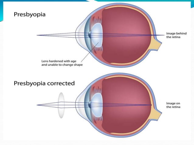 refractiveerror-200625072525.pptx. . | PPT