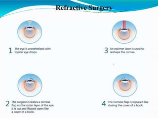 refractiveerror-200625072525.pptx. . | PPTX