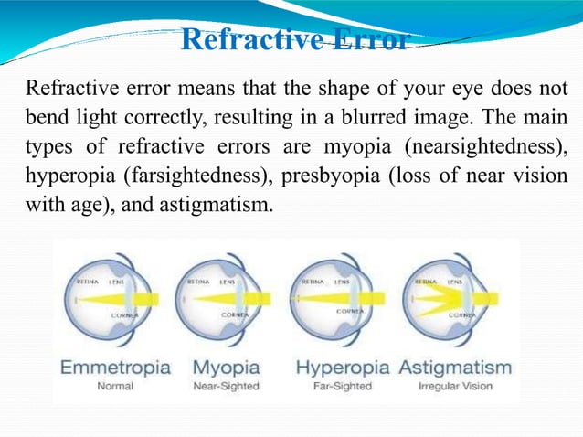 refractiveerror-200625072525.pptx. . | PPT