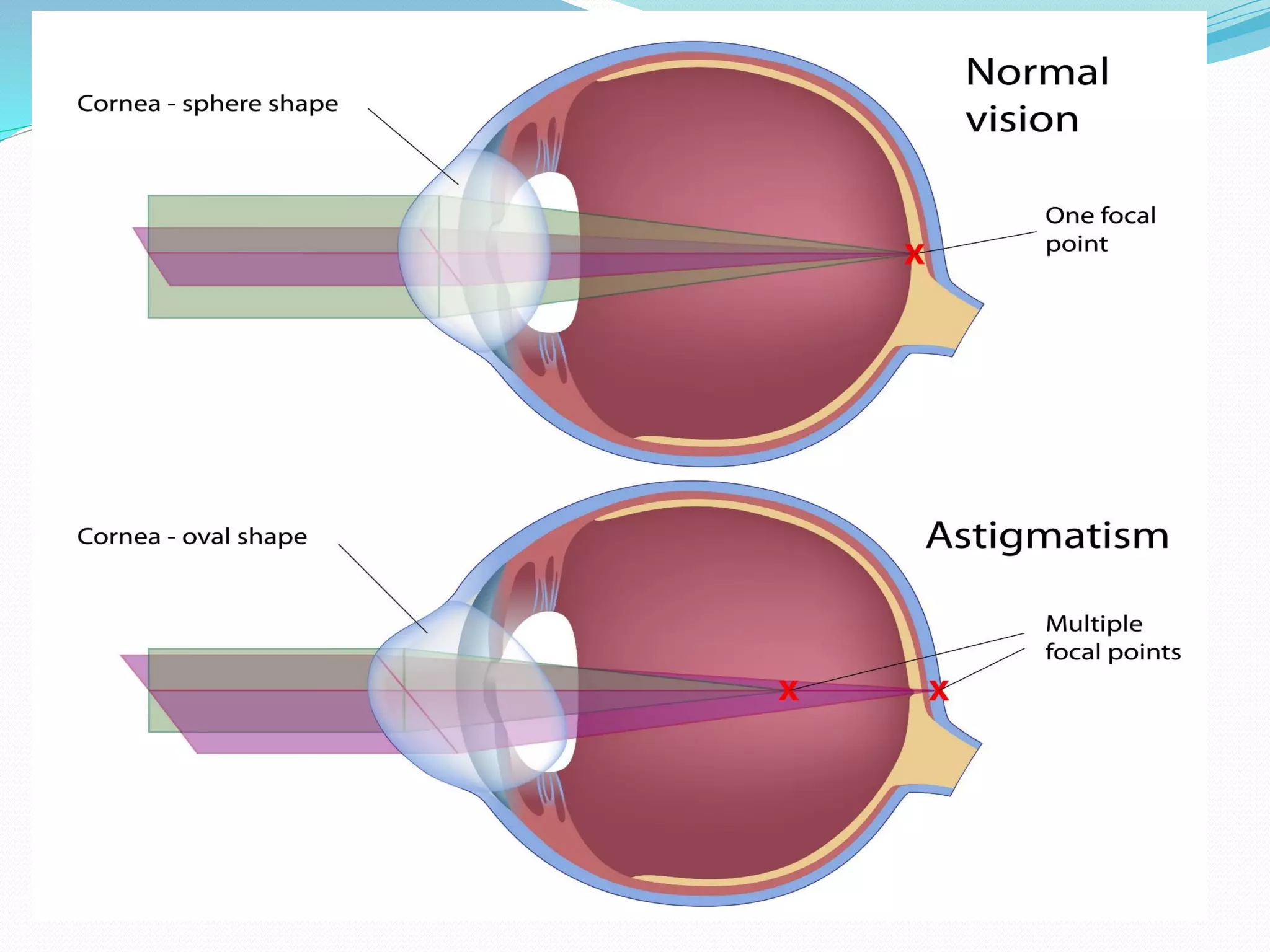 Refractive error | PDF