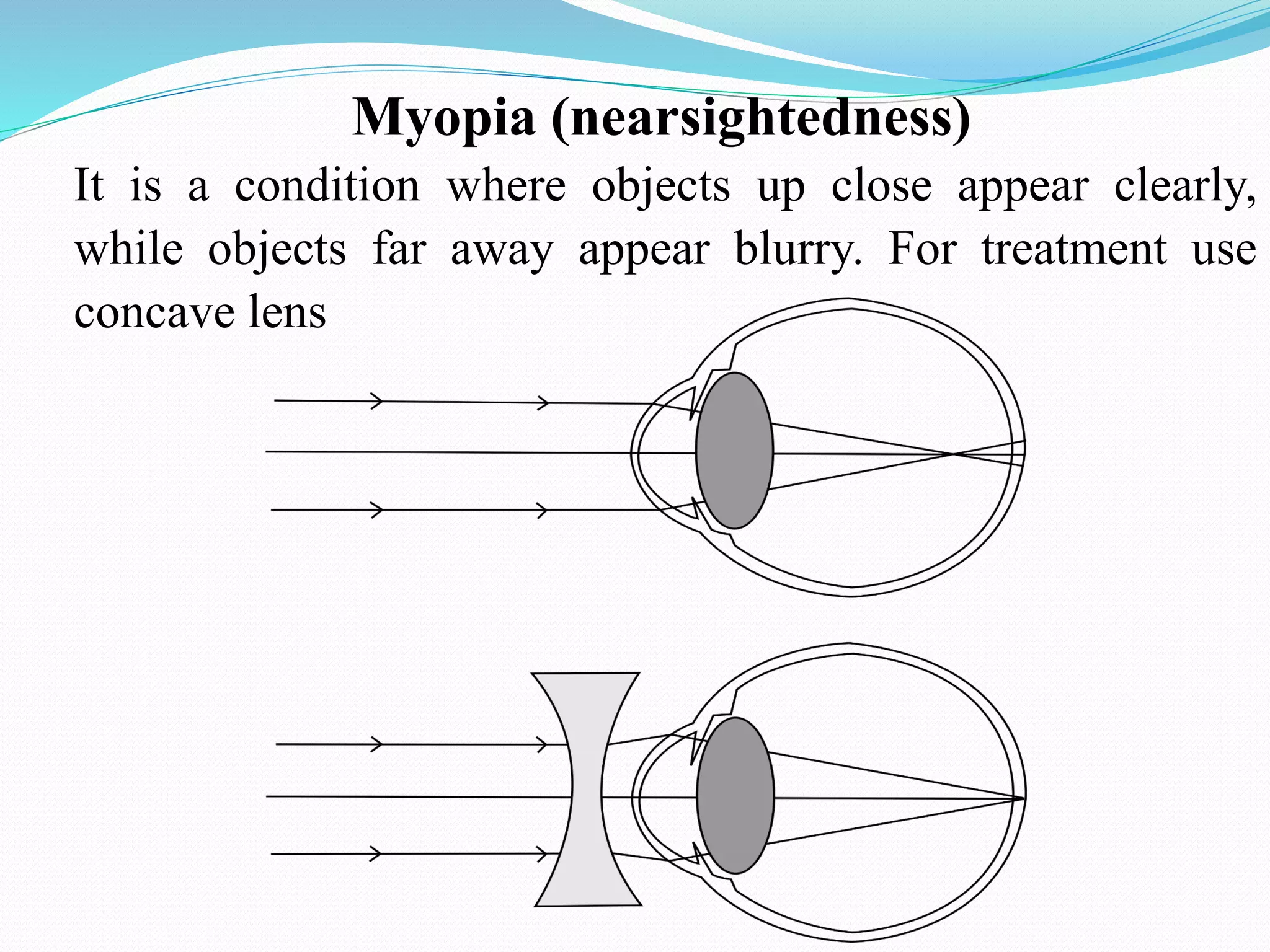 Refractive error | PDF | Eye and Vision Conditions | Diseases and ...