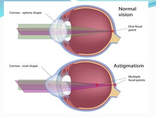 Refractive error | PPT